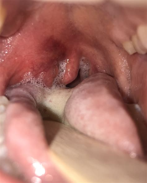 Peritonsillar Abscess