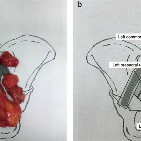 Sentinel Lymph Node Specimens Mapped On The Scheme A And Grouped Into Download Scientific