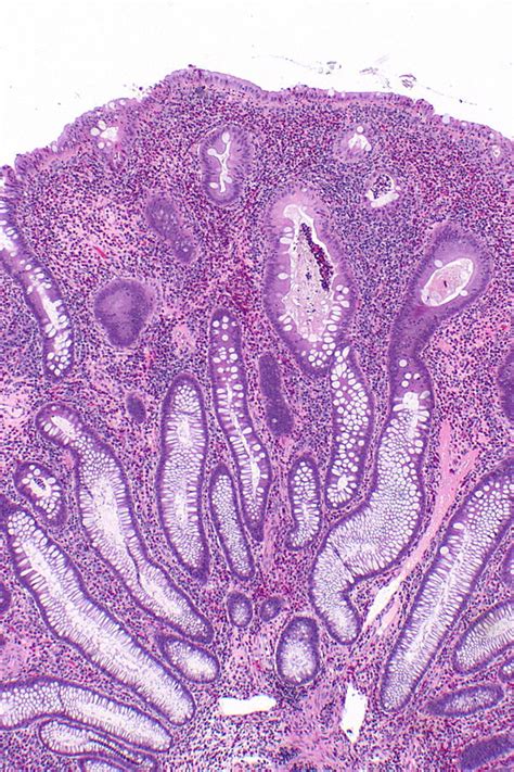 Inflammatory Pseudopolyp Libre Pathology