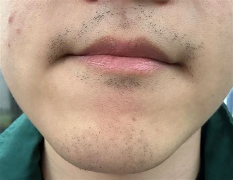 수염 레이저 제모 후기 젠틀맥스프로 플러스 5회 아포지플러스 2회차