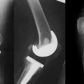 Tibia Surface Matching Case Left Reference Clamp Attached To The Download Scientific