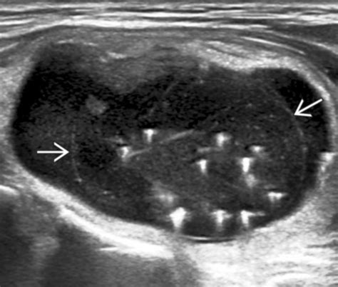 Thyroid Nodule Cases Integrated Session Thyroid Nodule Flashcards Quizlet