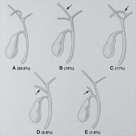 Pdf Congenital Cystic Lesions Of The Biliary Tree