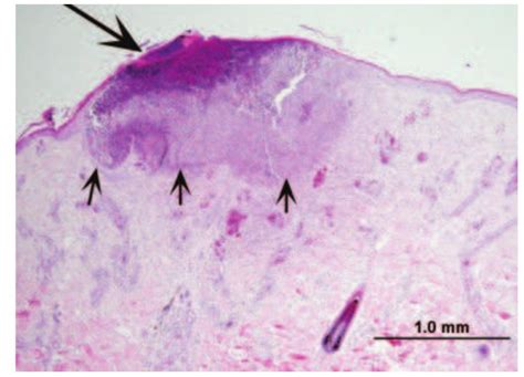 Photomicrograph Of Skin Biopsy Specimen From The Alpaca In
