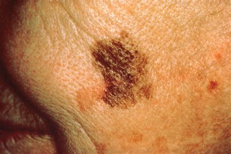 Whats The Biggest That Melanoma In Situ Can Grow Scary Symptoms