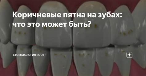 Коричневые пятна на зубах что это может быть Стоматология Roott Дзен