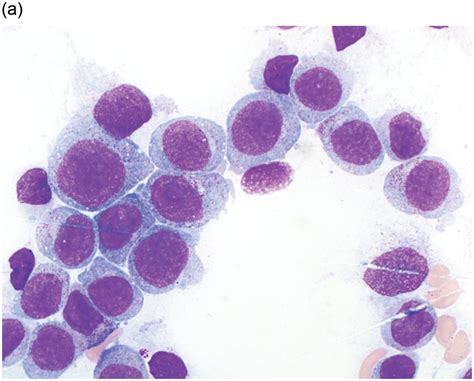 Monocytic Blasts