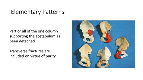 Acetabulum Fractures Anatomy Radiological Evaluation Classification Acetabulum Fractures Anatomy Radiological Evaluation Classification