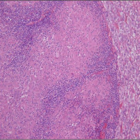 Abdominal Ct There Is Multi Nodular Thickening Of Left Adrenal Gland Download Scientific