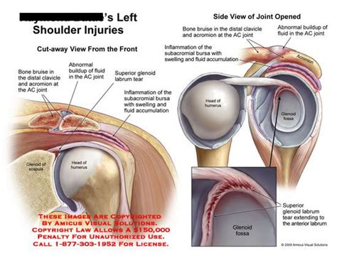 13 Best Glenoid Labrum Tear Images On Pinterest Physical Therapy