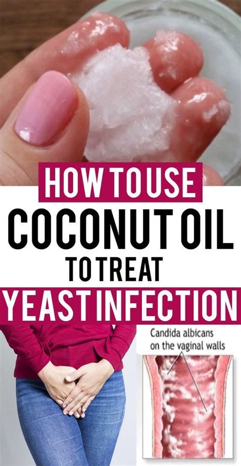 How To Use Coconut Oil For Yeast Infection Buzzhome World Treat Yeast Infection Yeast