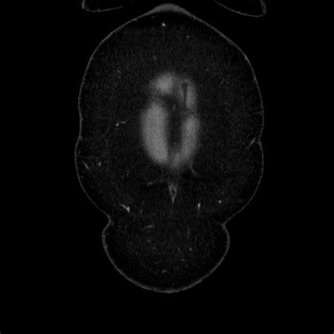 Fileperforated Sigmoid Diverticulitis With Abscess