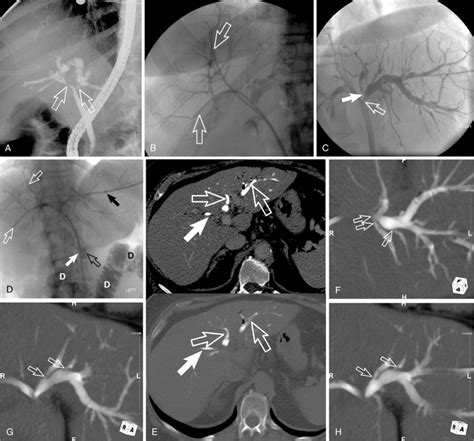 Percutaneous Management Of Cholangiocarcinoma Oncohema Key