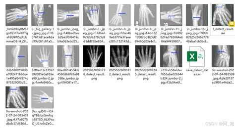基于yolo11深度学习的医学x光骨折检测与语音提示系统【python源码pyqt5界面数据集训练代码】 Csdn博客