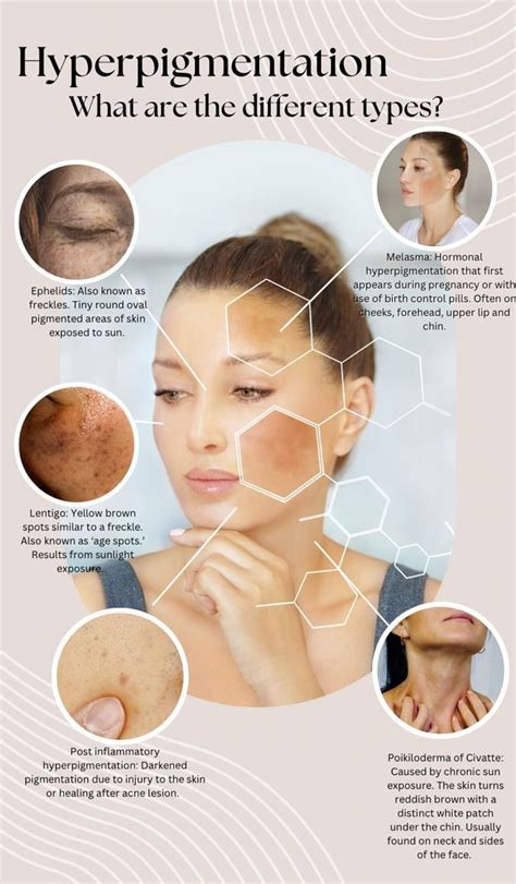 Hyperpigmentation And Its Types Infographic
