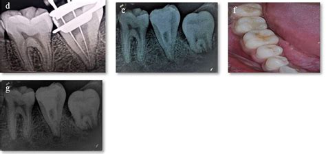 A Preoperative Radiograph Showing Type Iii Fan Classification B