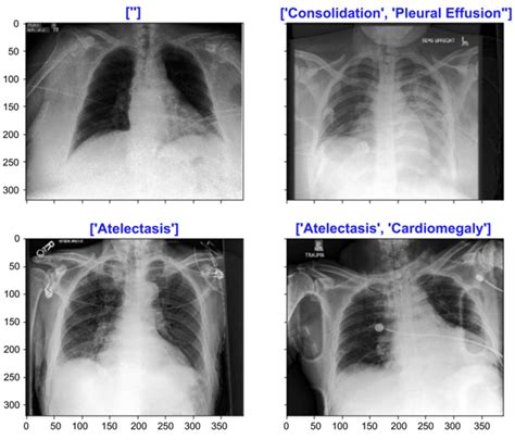 Multi Label Chest X Ray Classification Via Deep Learning Papers With Code
