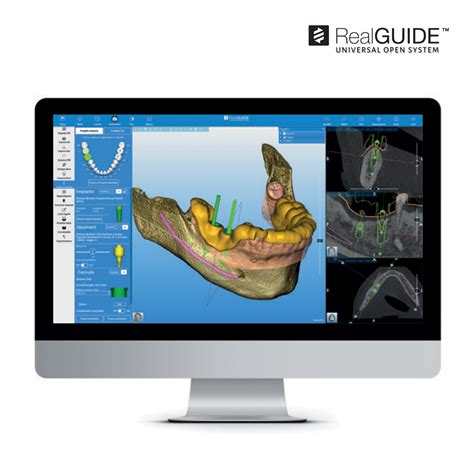 encode® emergence healing abutments zimvie digital solutions