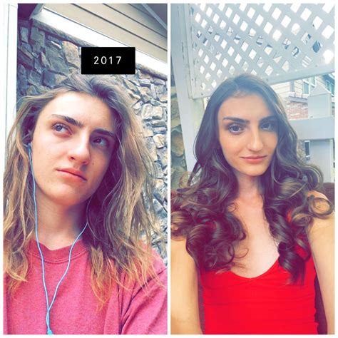 Before And After Estrogen Rtranstimelines