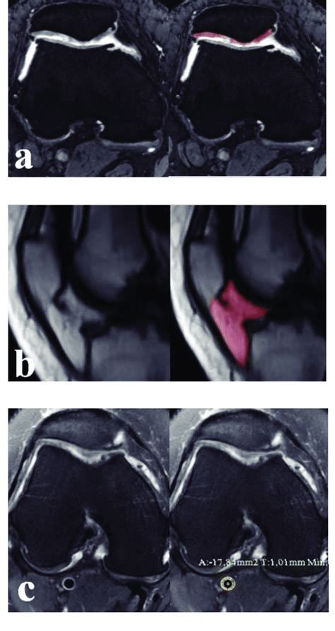 A 48 Year Old Woman With Grade 3 Chondromalacia A Patellar Cartilage
