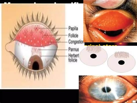 Conjunctival Diseases By Dr Abdul Basir Safi Ppt Ear Nose And