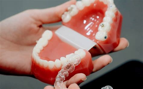 Invisalign A Step By Step Guide To Straighter Teeth