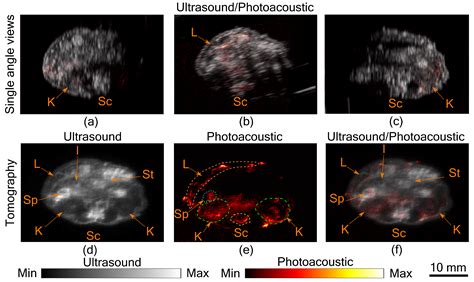 Tomographic Ultrasound And Led Based Photoacoustic System For