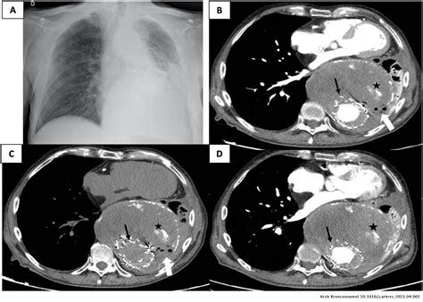 Aortobronchopulmonary Fistula—an Unusual Cause Of Hemoptysis Archivos De Bronconeumología