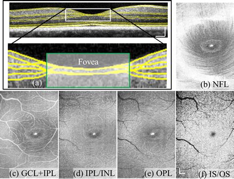 User Guided Segmentation For Volumetric Retinal Optical Coherence Tomography Images