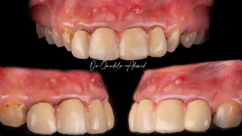 To Splint Or Not To Splint When Brain Gears Work More Than Neurotransmitters Myzerodonto