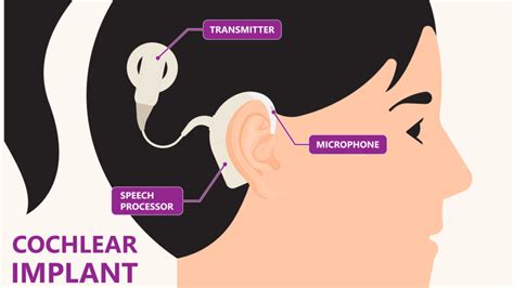 Cochlear Implants For Single Sided Deafness A Comprehensive Guide To Better Hearing Baxter