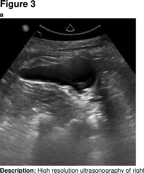 Figure 3 From Mucocele Of Appendix A Case Report And Review Of