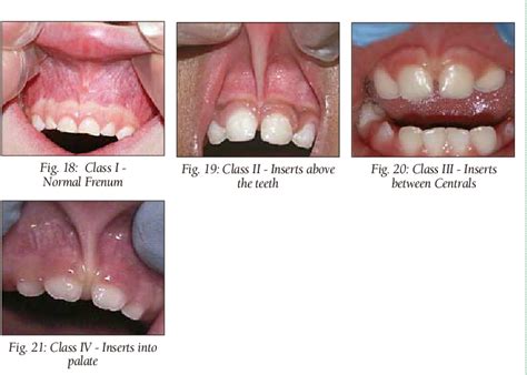 Figure 18 From Oral Diagnosis Of Abnormal Frenum Attachments In Neonates And Infants Evaluation