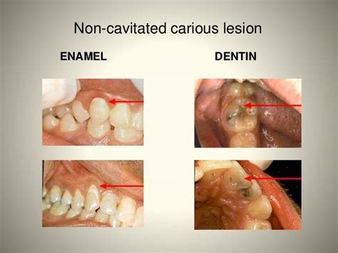 Detection And Diagnosis Of Dental Caries