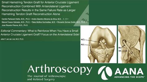Arthroscopy Journals On Linkedin Anterolateralligament Acl
