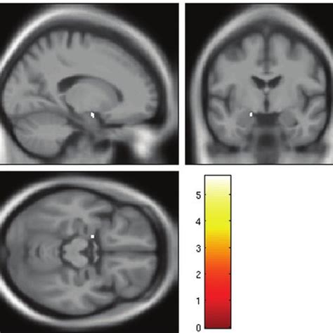 Spm8 Glass Brain Representation A Of Voxelwise Analysis Between Download Scientific