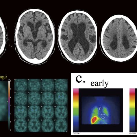 A Brain Computed Tomography Showed Disproportionately Enlarged