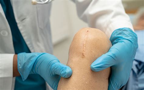 Performing Total Joint Surgeries Outpatient In Ascs Or Today