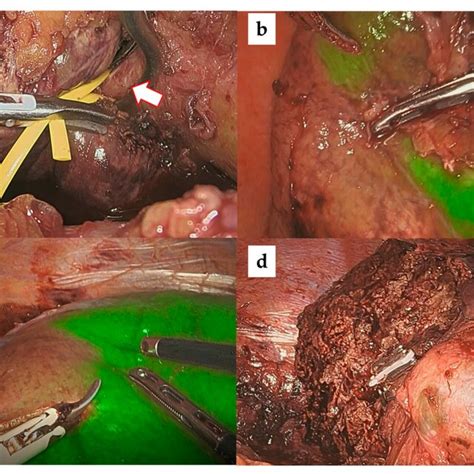 Laparoscopic Left Hepatectomy With Icg Negative Staining A Securing Download Scientific