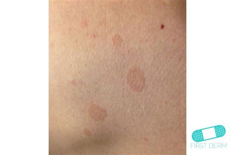 Pityriasis Versicolor Tinea Verisicolor Online Dermatologist