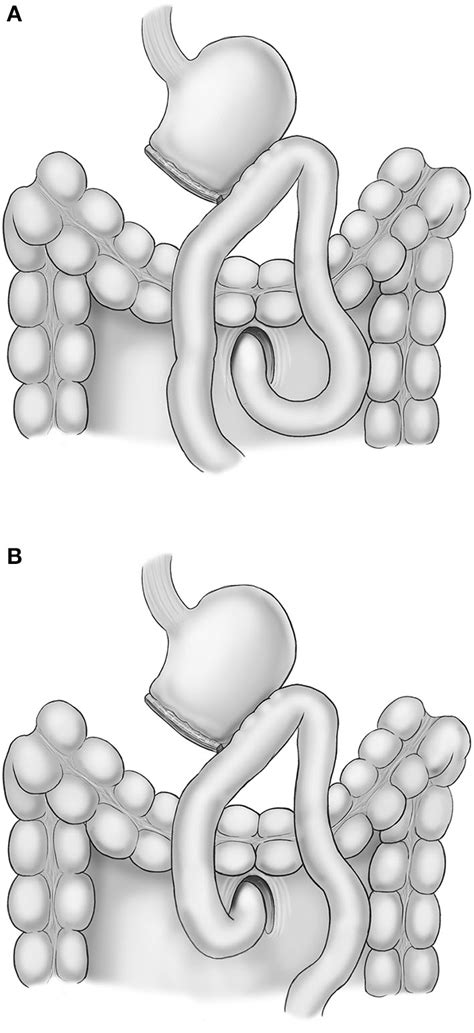 Scheme Of Isoperistaltic Gastrojejunostomy A And Antiperistaltic Download Scientific Diagram