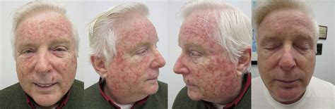 Fluorouracil Cream Uses Side Effects And Before And After