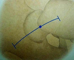 Bipolar Hip Replacemant At Best Price In New Delhi By Anuvrat Clinic ID 7576686788