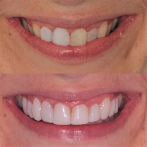 Invisalign And Composite Bonding Case 2 Headrow Dental