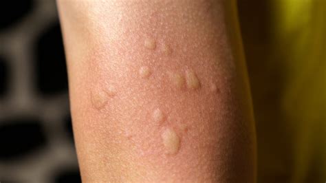 Understanding Hives Urticaria Symptoms Causes And Treatment Options At Jiva Health Jiva