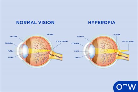Hyperopia Farsightedness Definition Causes Symptoms Diagnosis