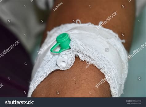 349 Scalp Vein Images Stock Photos Vectors Shutterstock