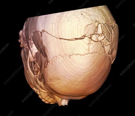 Skull Fractures 3d Ct Scan Stock Image C0389358 Science Photo Library