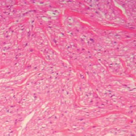 Spindle Cell Neoplasm With Multidirectional Beams Formed By Spindle Download Scientific Diagram