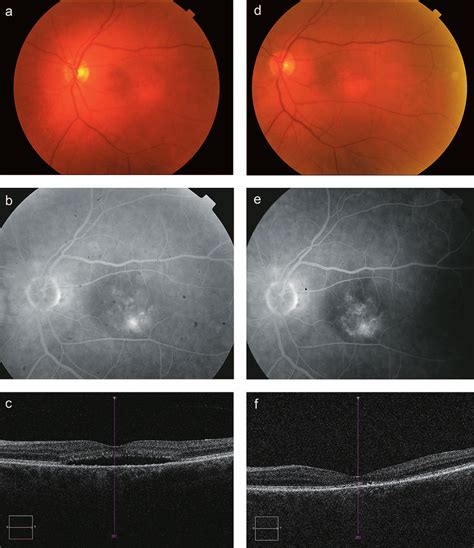 Central Serous Retinopathy Differential Diagnosis